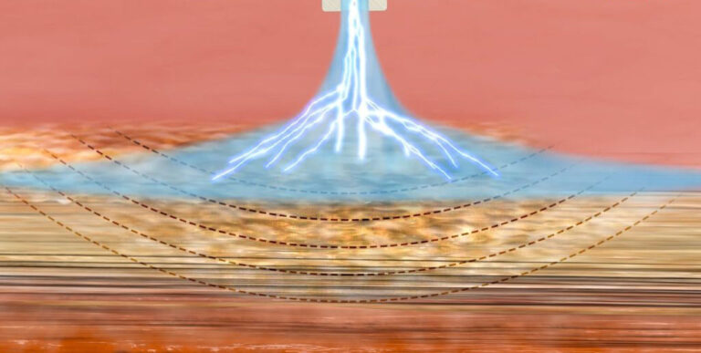 Argon Plasma Coagulation - Medigenix
