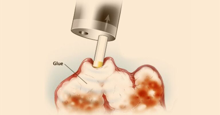 Endoscopic Glue Injection - Medigenix