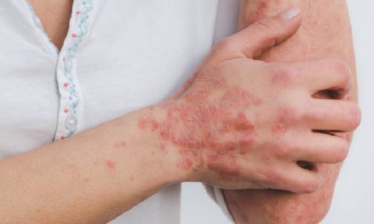 Intralesional Injection - Medigenix